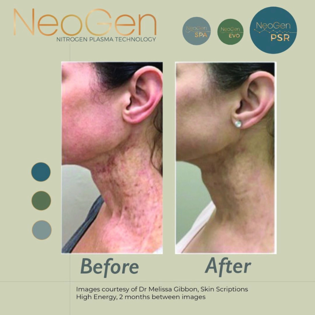 NeoGen Offer LP – Seaside Skin Care